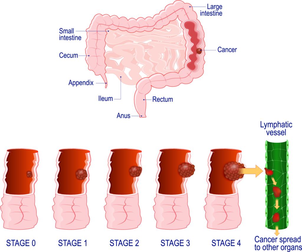 Colon Cancer - Hisar Intercontinental Hospital
